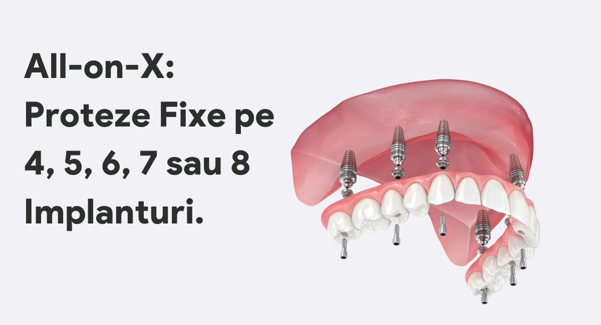 Allonx.md: Proteze Dentare All-on-X pe 4, 5, 6, 7 sau 8 Implanturi